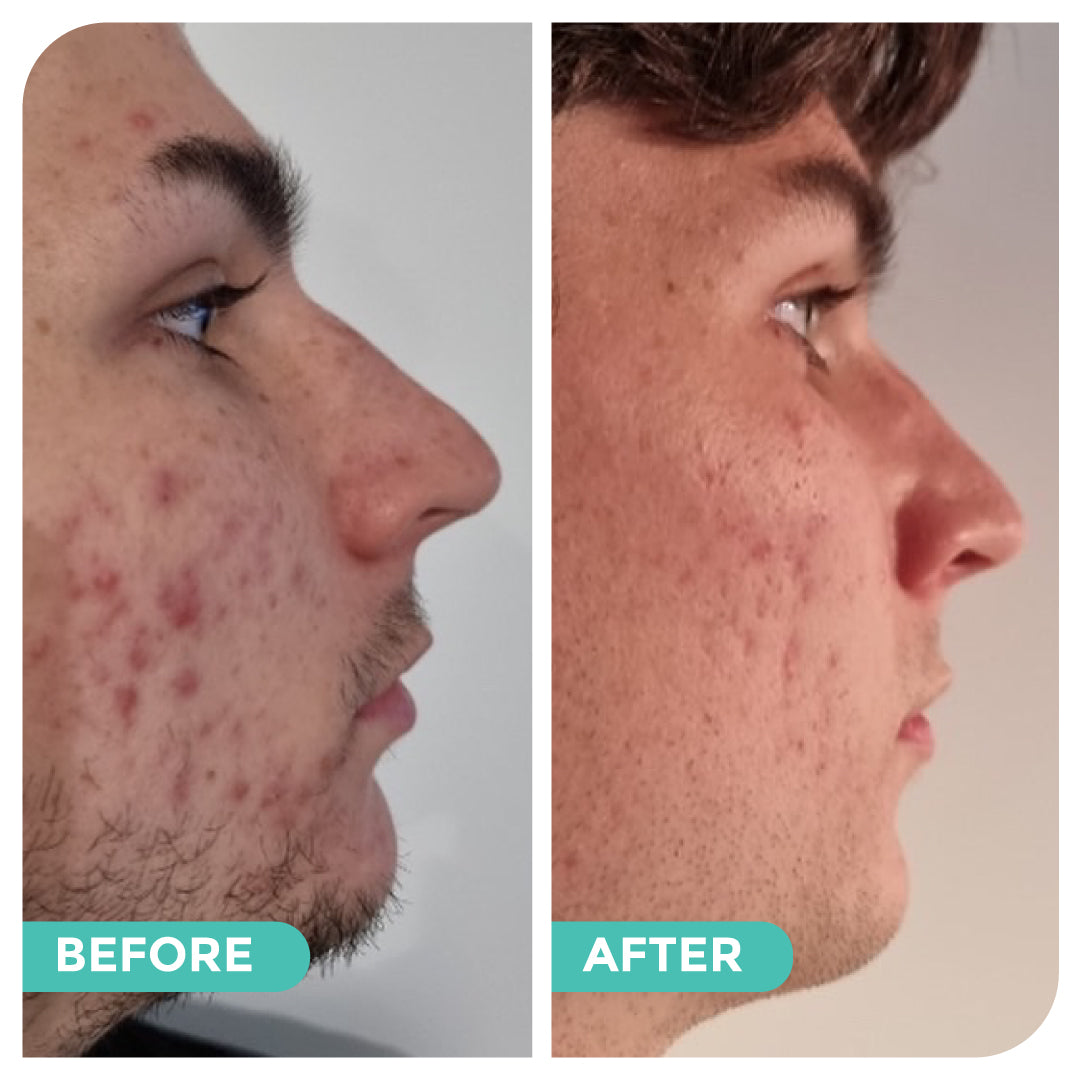 Hemp Seed Oil: A Natural Remedy For Acne – Hemp Co Australia